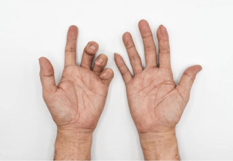 The 7 Stages of Stroke Recovery | Dr. Gurneet Singh Sawhney