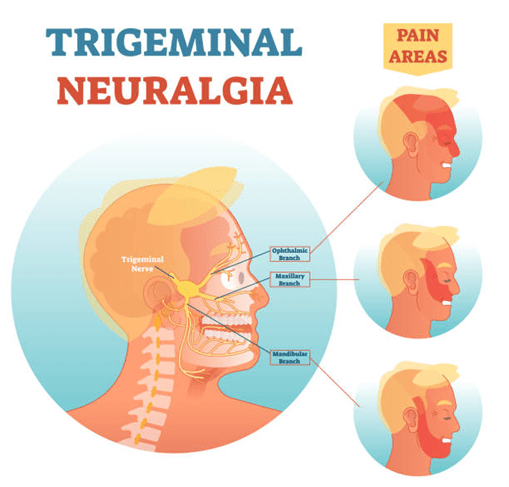 Trigeminal Neuralgia and Tongue Pain