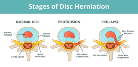 Understanding Recurring Slipped Disc | Dr Gurneet Singh Sawhney