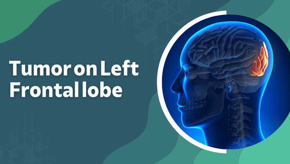 Tumor on Left Frontal Lobe | Dr. Gurneet Singh Sawhney