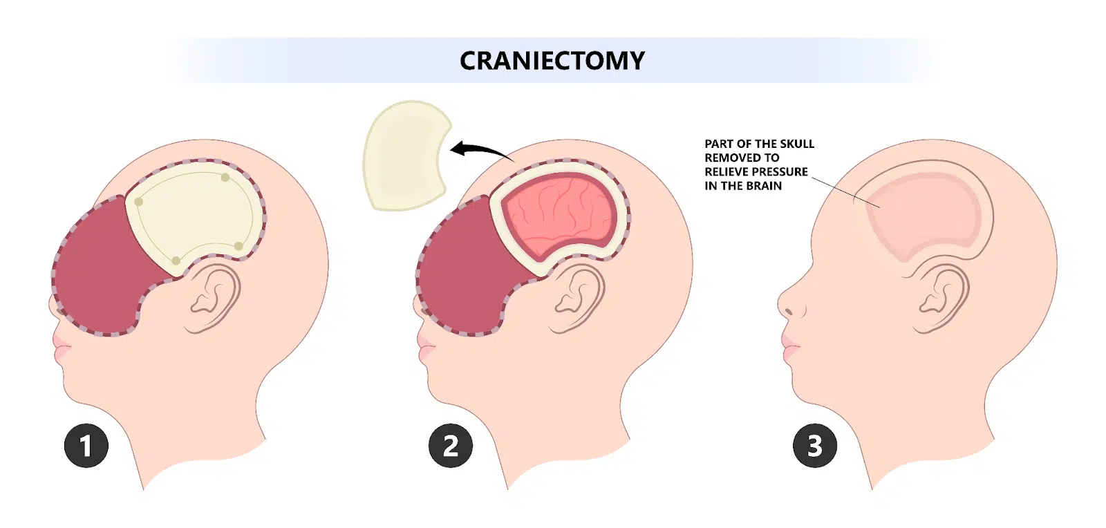 Craniotomy Vs Craniectomy: 4 Key Differences Explained by a ...
